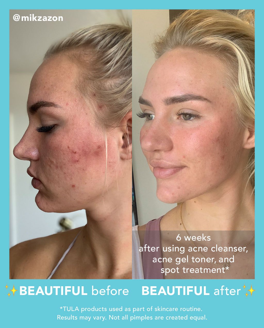 Acne Clearing + Tone Correcting Gel – ooni11.com